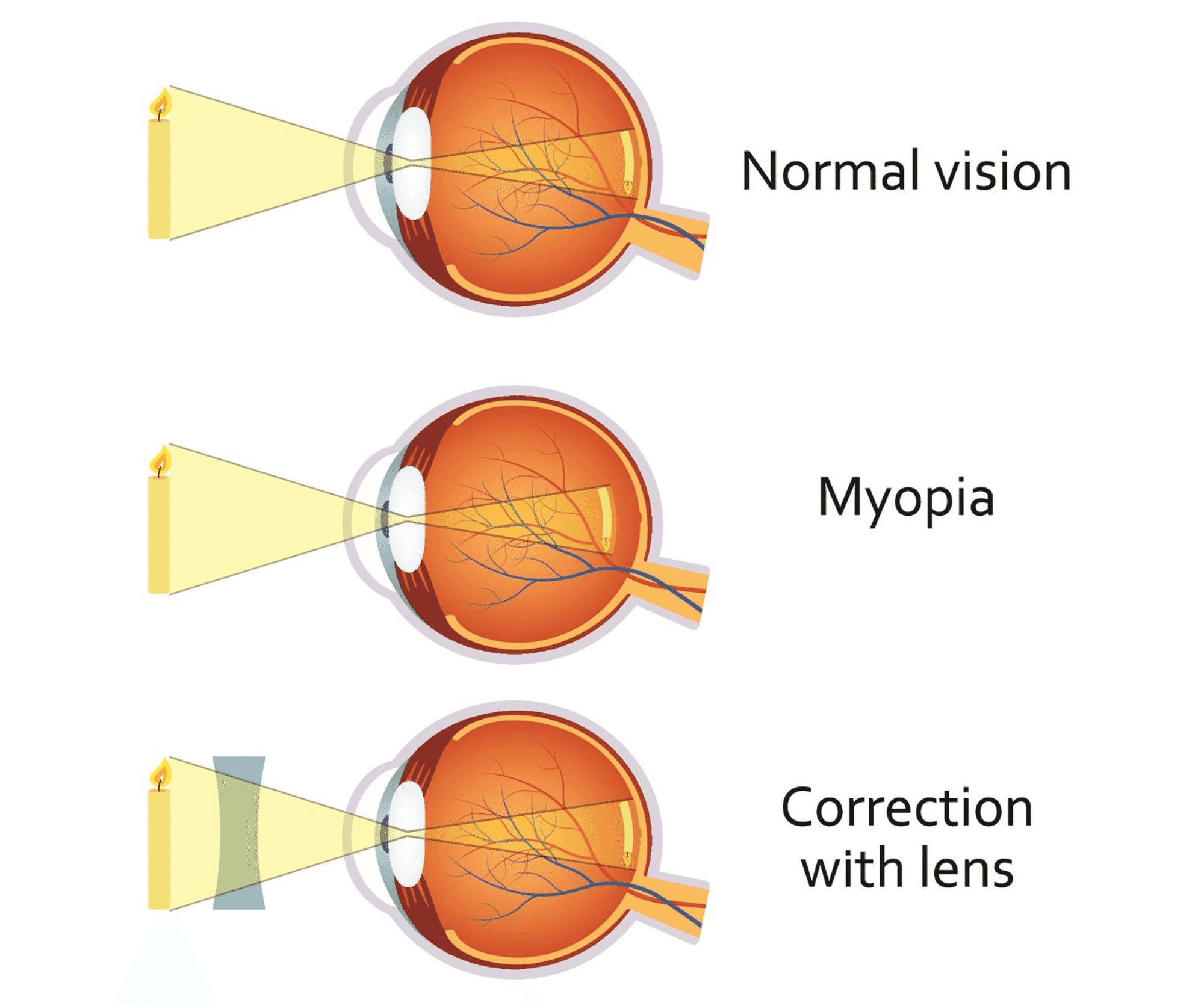 Myopia | Blackheath Eyecare Opticians | Charlton Opticians, South East London